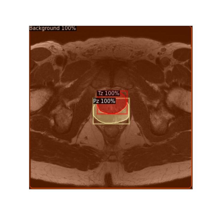 Prostate MRI — Haider Lab