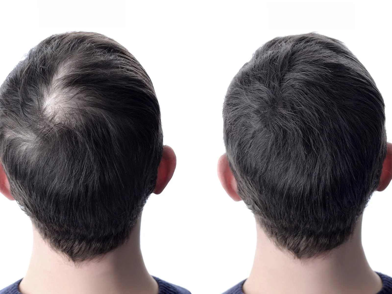 PRP Hair Loss Therapy — Restore Aesthetic & Skin Clinic
