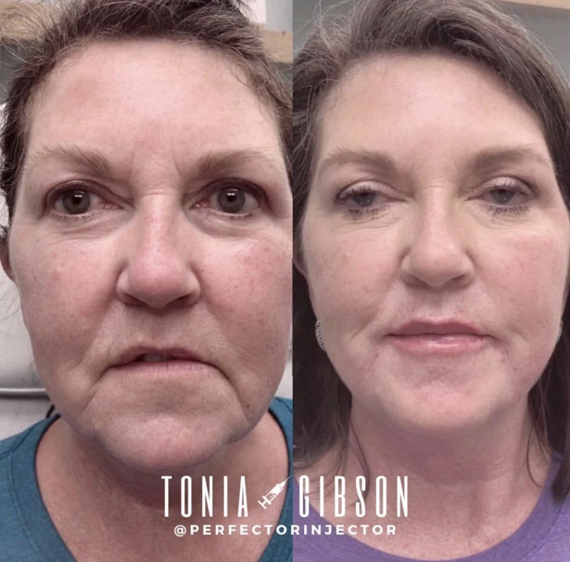 Injectables — GLOW Medical Spa