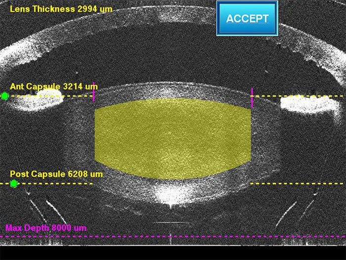 Laser Cataract Surgery | Enhance Vision Today — Schedule Now — Lake ...