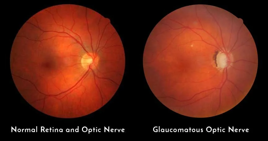 Glaucoma Testing and Treatment | Schedule Your Glaucoma Checkup Today ...