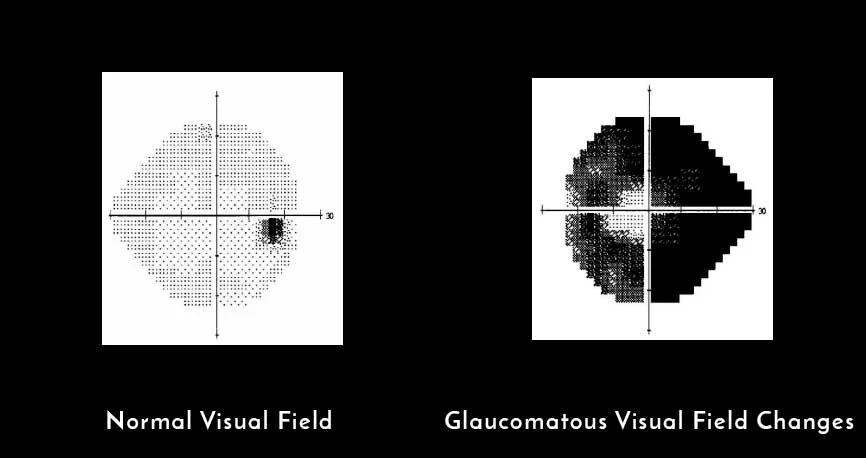 Glaucoma Testing and Treatment | Schedule Your Glaucoma Checkup Today ...