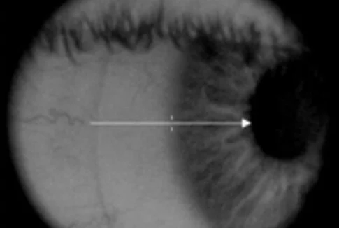 Scleral Contact Lenses for Keratoconus — Contact Lens Fitting Brisbane ...