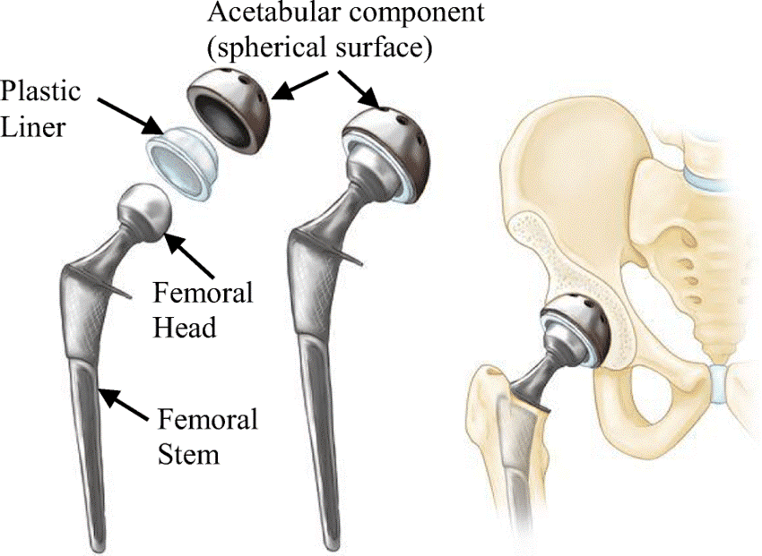 Hip Resurfacing — G2Orthopaedics | George J McLauchlan | Lancashire ...