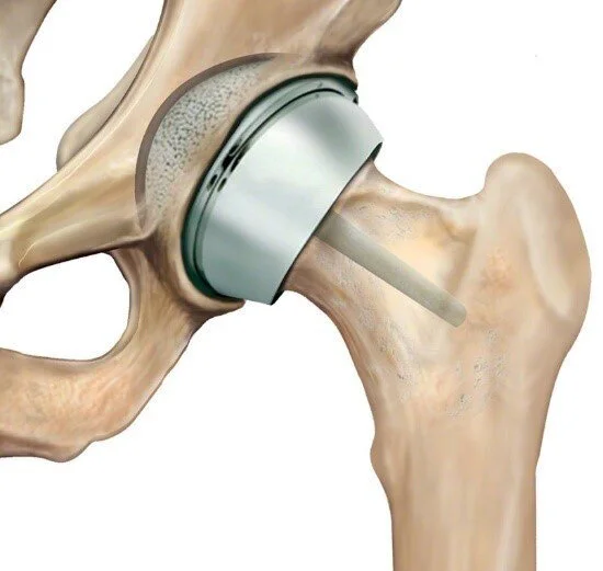 Hip Resurfacing — G2Orthopaedics | George J McLauchlan | Lancashire ...
