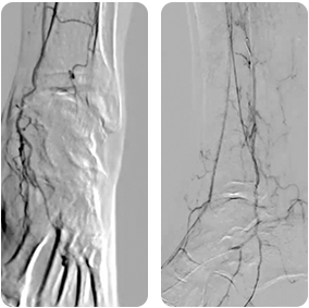 Case Reports — Sublime™ Radial Access Platform