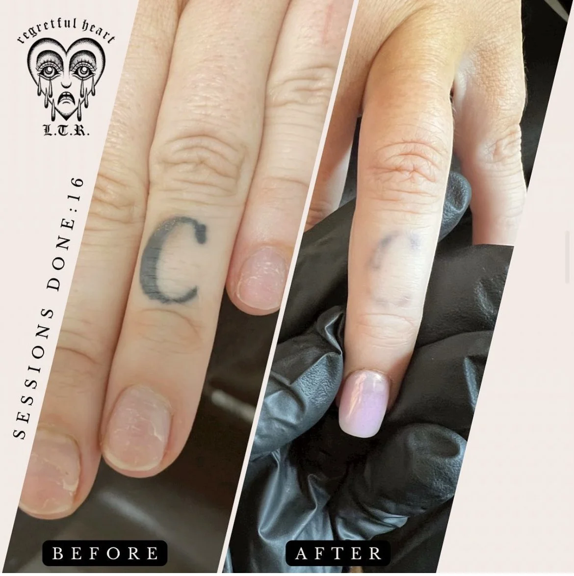 Regretful Heart Laser Tattoo Removal in Richmond VA