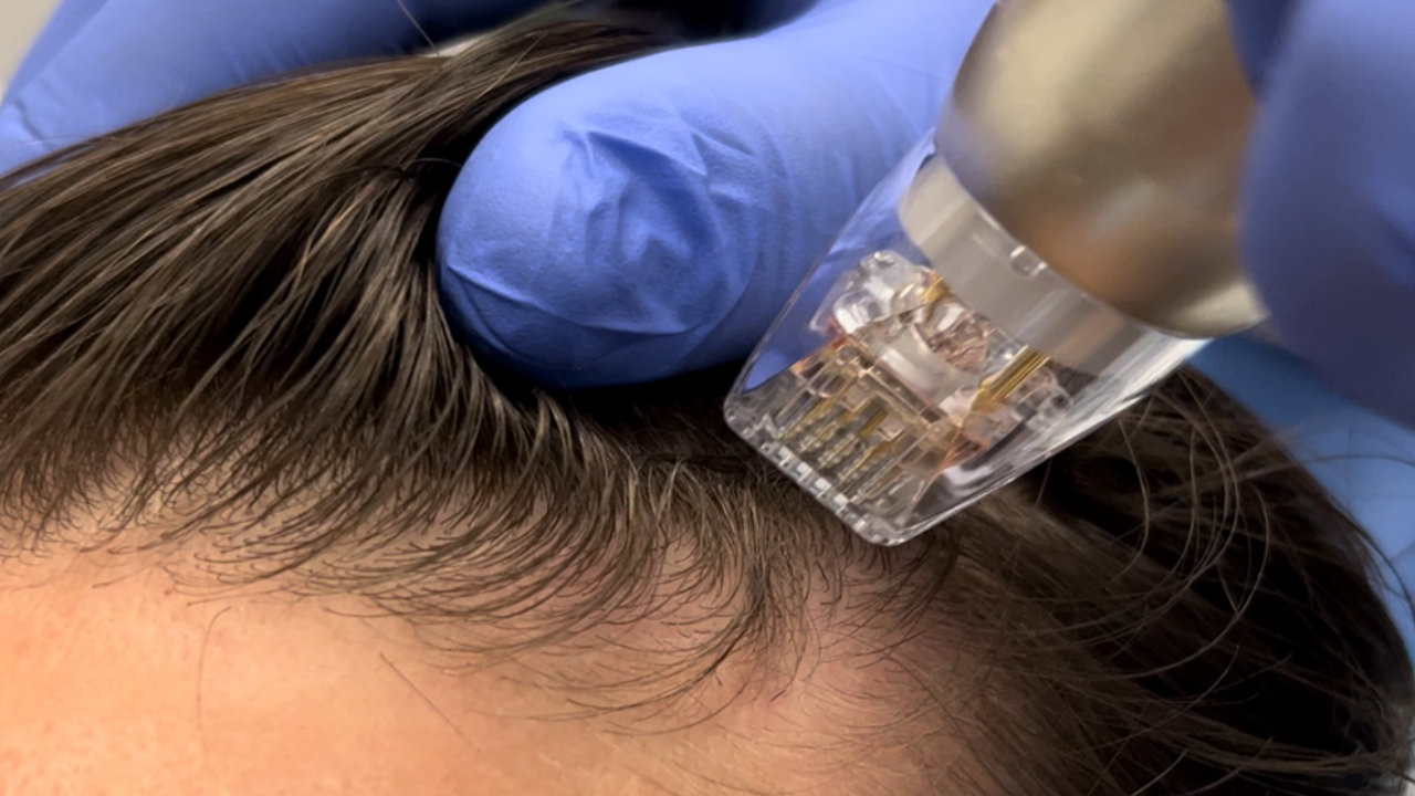 Calabasas Hair Growth Med Spa Treatments — Dr. Erin Gordon - Aesthetics