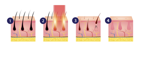 Calabasas Viora Hair Removal — Dr. Erin Gordon - Aesthetics