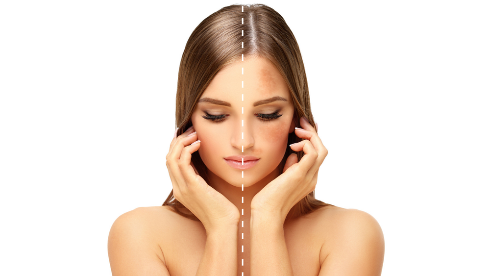 How to tackle hyperpigmentation- IPL photo facial — Dr. Erin Gordon ...