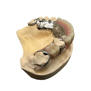 What Are Chrome Dentures? | All Smiles Denture Clinic