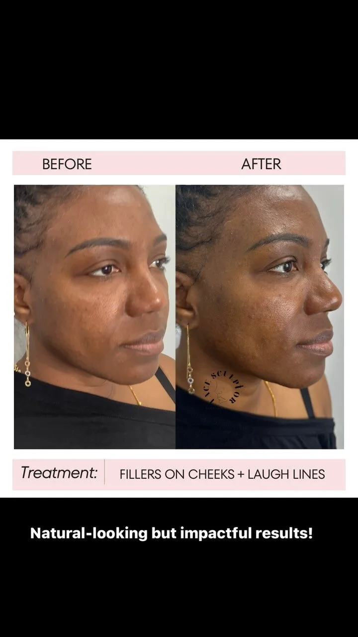 Face Sculptor Medical Aesthetic Clinic | Nurse Cheska | Lip Filler Near ...