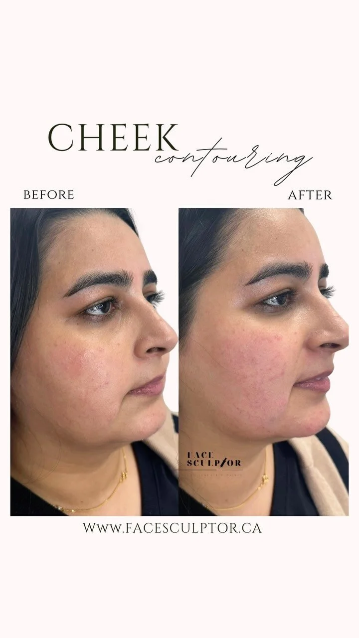 Face Sculptor Medical Aesthetic Clinic | Nurse Cheska | Lip Filler Near ...