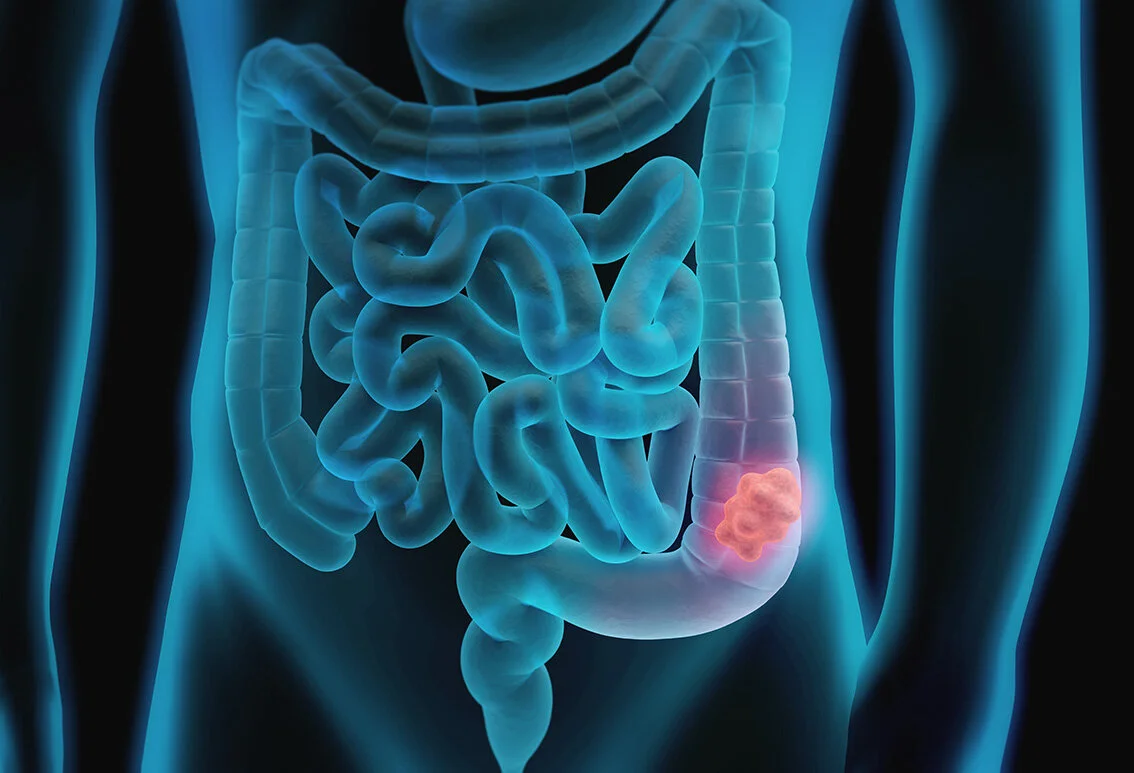 Bowel Obstruction Surgery Brisbane Sunnybank Surgical Group