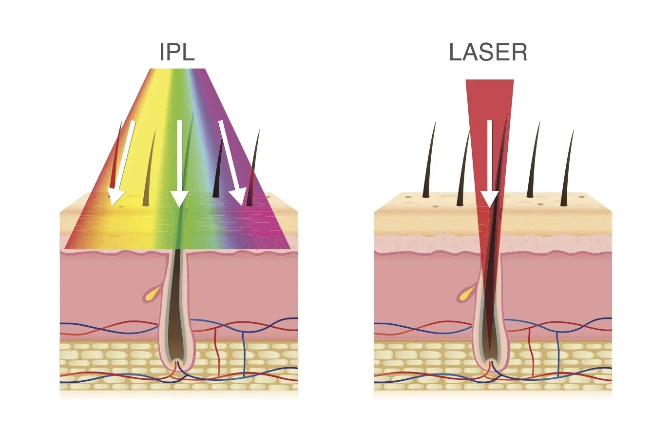 Les différents types de laser — Aria SkinLaser