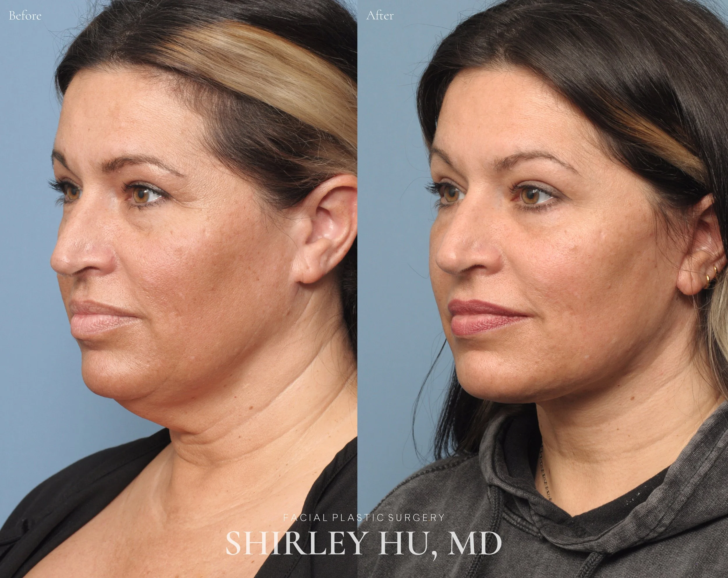 Facelift & Neck Lift — New York Facial Plastic Surgery