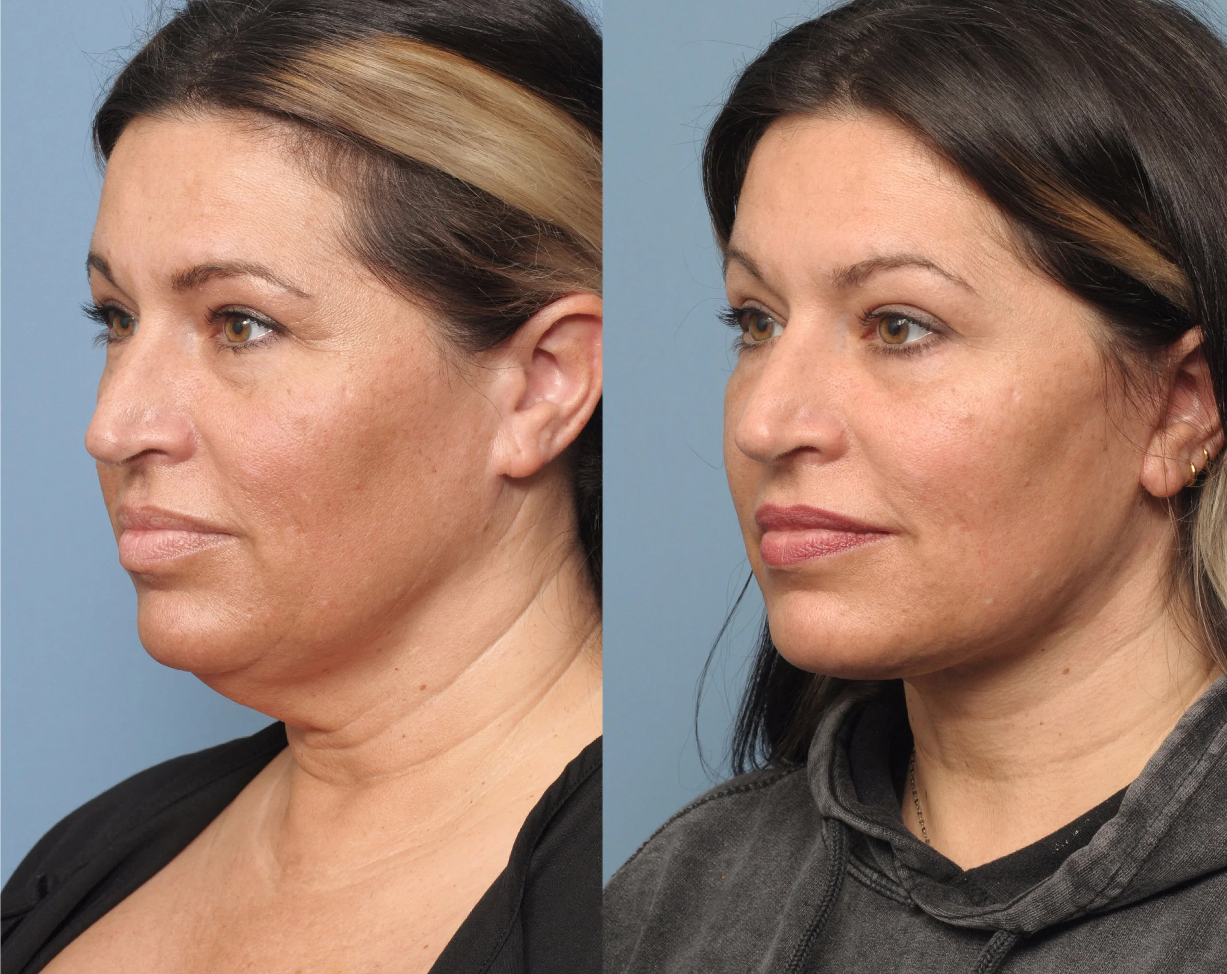 Facelift — New York Facial Plastic Surgery
