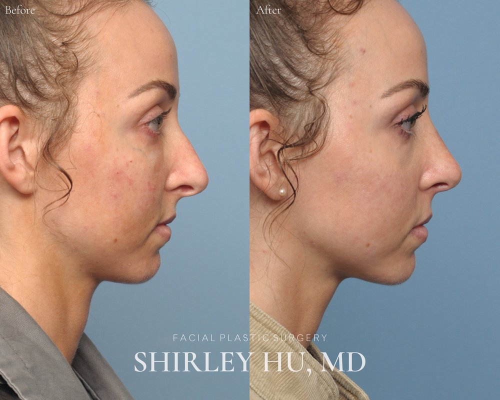 Rhinoplasty — New York Facial Plastic Surgery