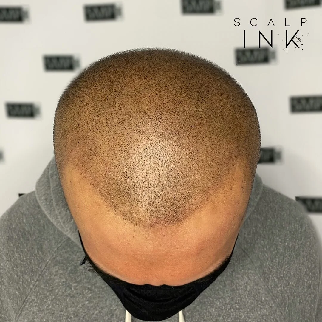 Scalp Ink LV