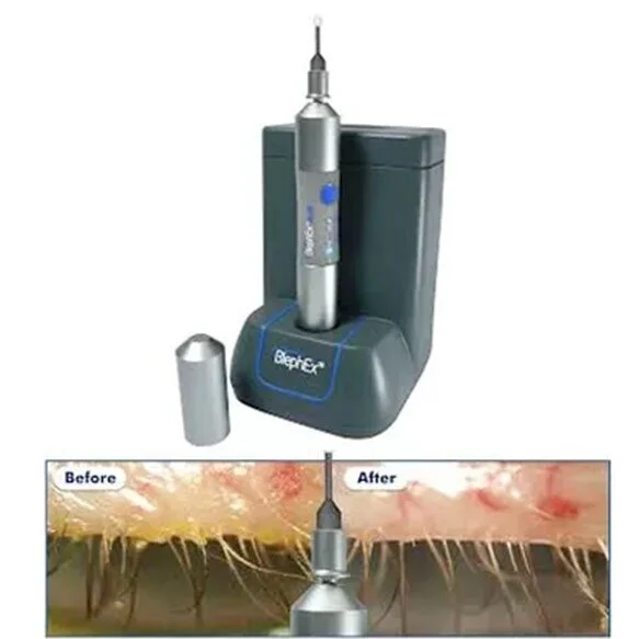 Blepharitis Treatment — Expert Eye Care, Arthur Hayes Opticians