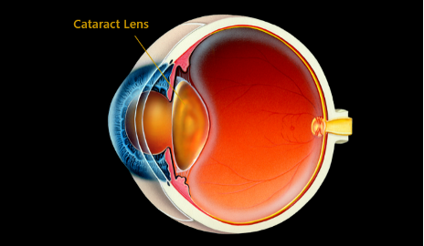Cataract — Expert Eye & Ear Care, Arthur Hayes Opticians
