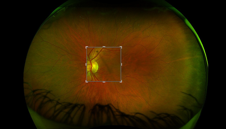 Eye Floaters explained — Expert Eye Care, Arthur Hayes Opticians