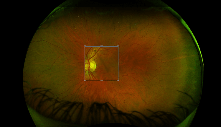 Eye Floaters explained — Expert Eye Care, Arthur Hayes Opticians