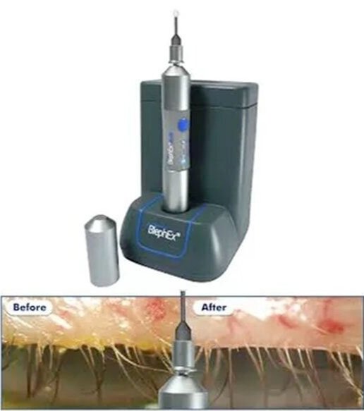 Blepharitis Treatment — Expert Eye Care, Arthur Hayes Opticians