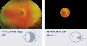Optomap Scanning — Expert Eye Care, Arthur Hayes Opticians