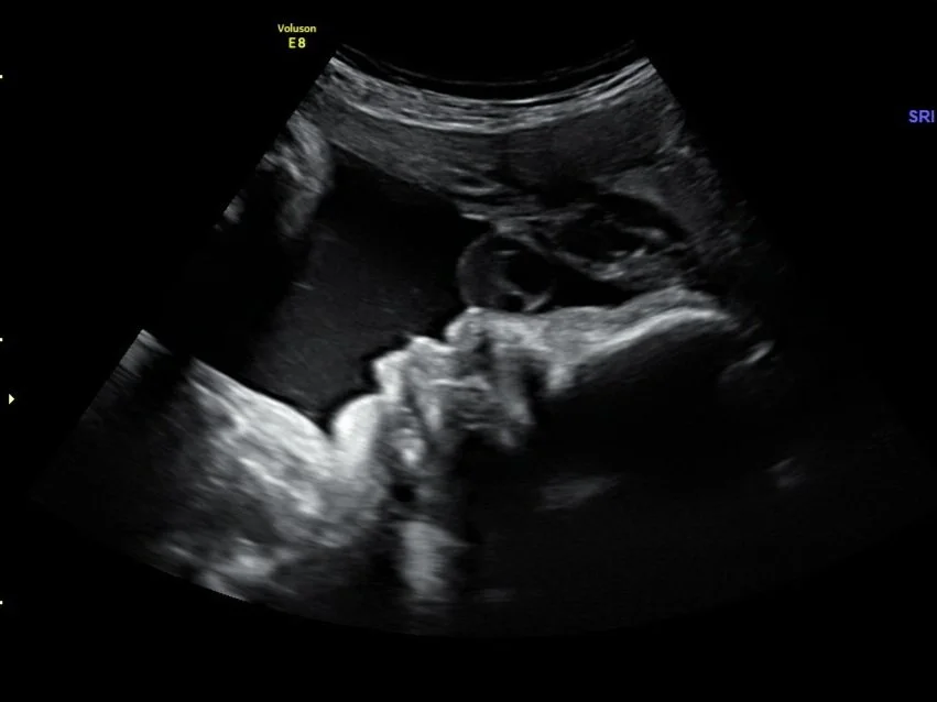 3d and 4d baby scan ultrasound Perth — 3D and 4D Ultrasound Scan Perth