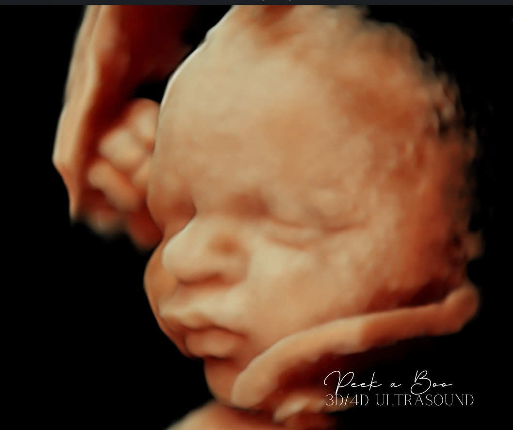 10 Weeks Pregnant 3d Ultrasound