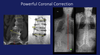 What is Prone Transpsoas Lateral Interbody Fusion (PTP LIF)?
