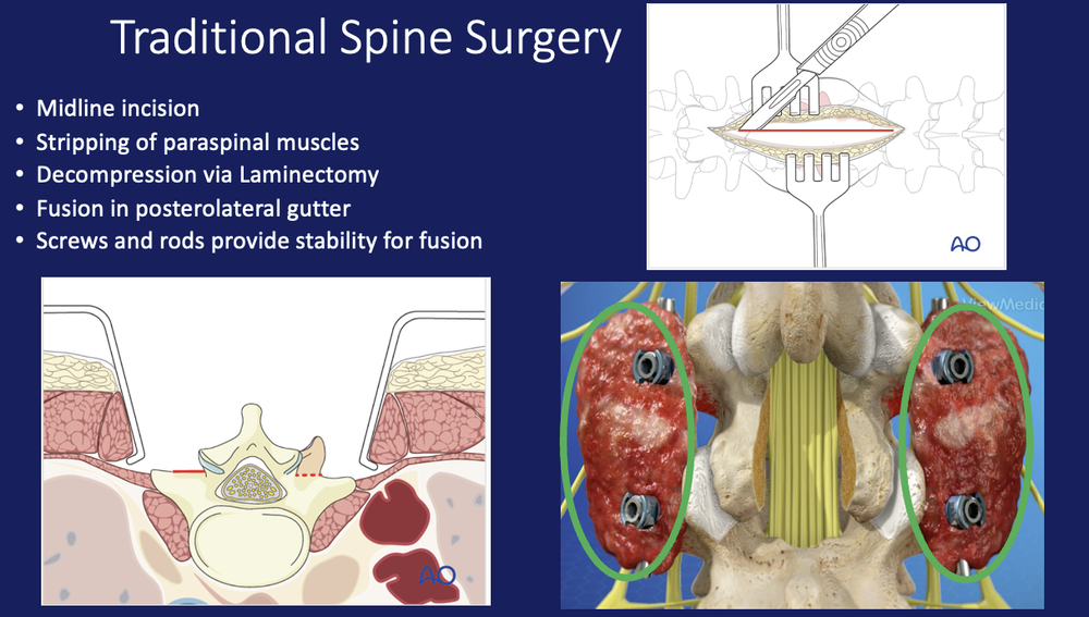 What is Prone Transpsoas Lateral Interbody Fusion (PTP LIF)?