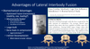 What is Prone Transpsoas Lateral Interbody Fusion (PTP LIF)?