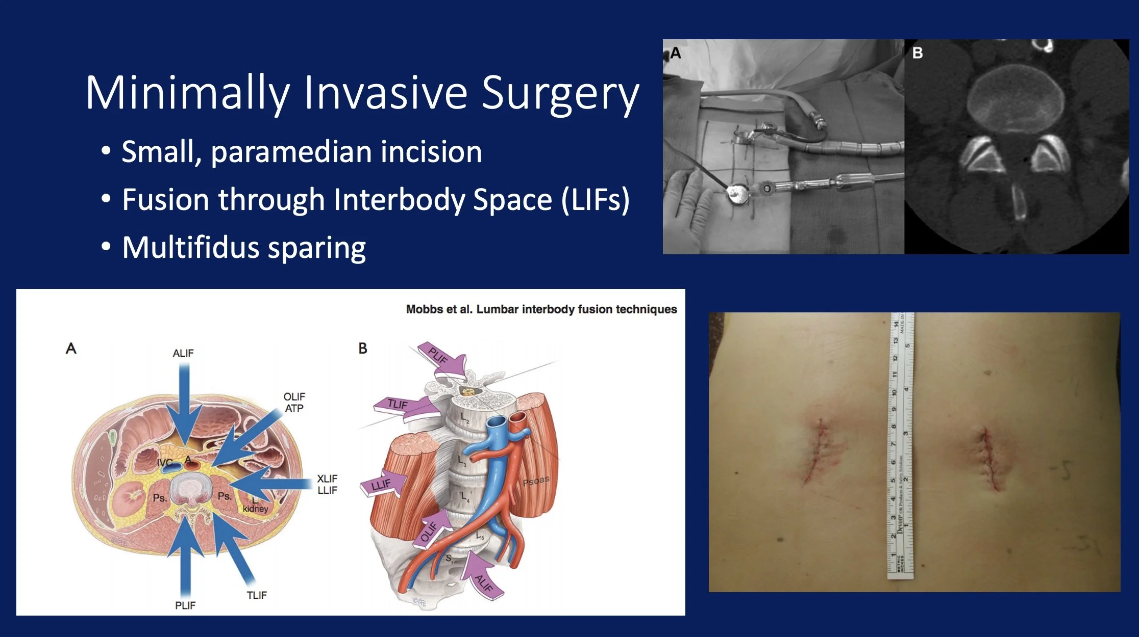 What is Minimally Invasive Spine Surgery?