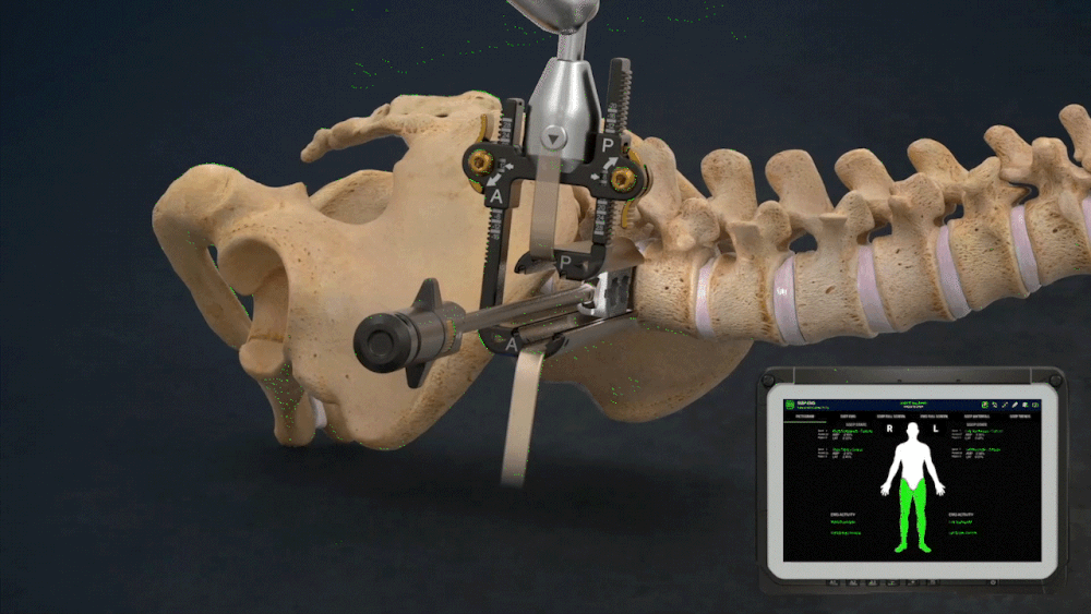 Orthopedic Spine Surgeon in Lafayette,IN | Dr. Zachary NaPier, MD