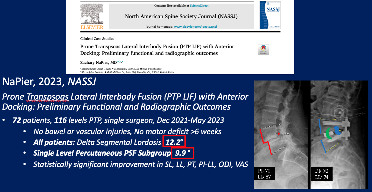 What is Prone Transpsoas Lateral Interbody Fusion (PTP LIF)?