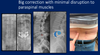 What is Prone Transpsoas Lateral Interbody Fusion (PTP LIF)?