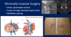 What is Prone Transpsoas Lateral Interbody Fusion (PTP LIF)?