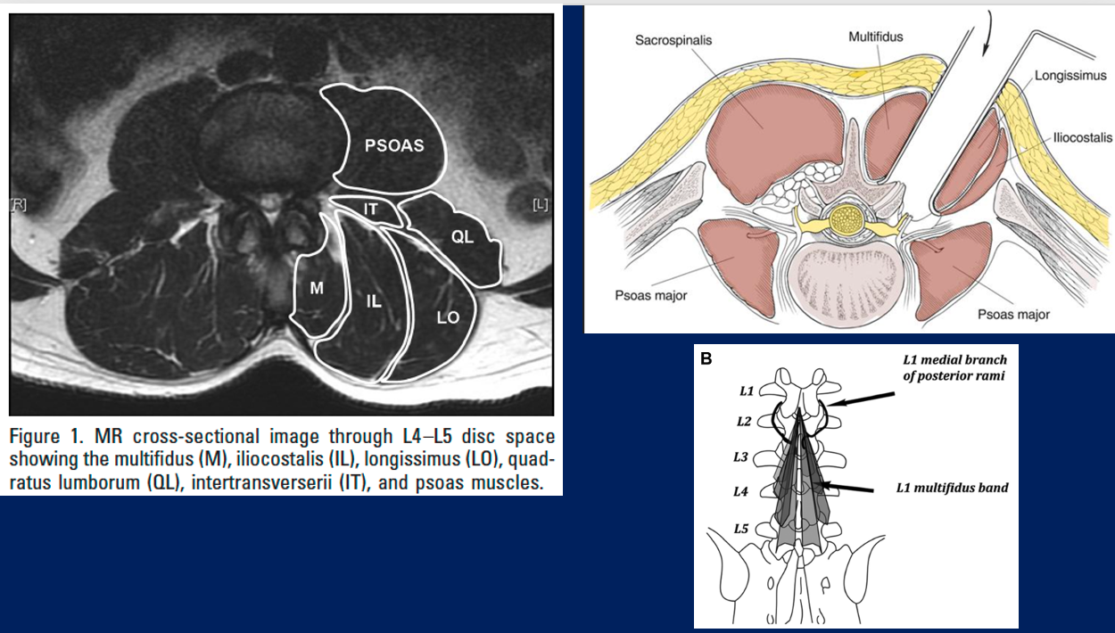 What is Prone Transpsoas Lateral Interbody Fusion (PTP LIF)?