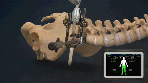What is Prone Transpsoas Lateral Interbody Fusion (PTP LIF)?
