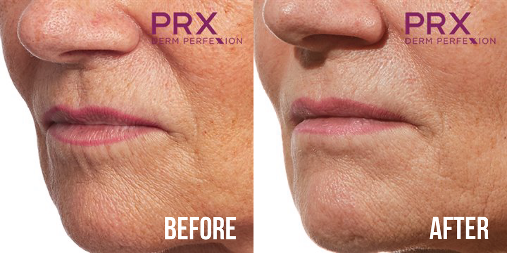 PRX Skin Treatment: What You Need to Know — M Dika Dermatology
