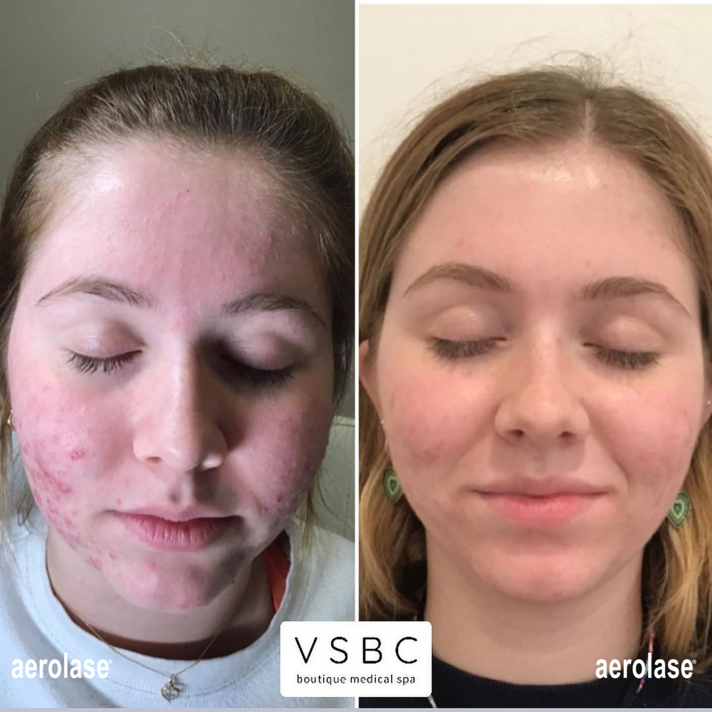 NeoDerm Laser by Aerolase — M Dika Dermatology