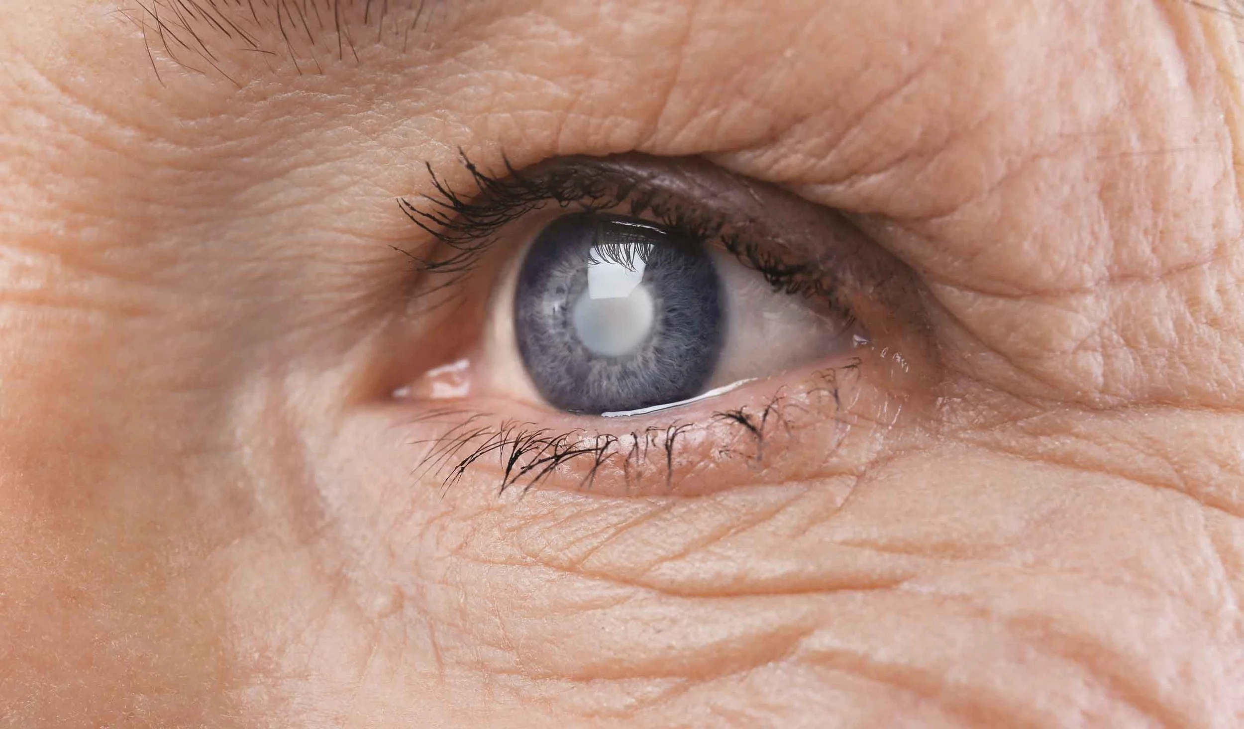Cataract Assessment | The Eyecare Spot