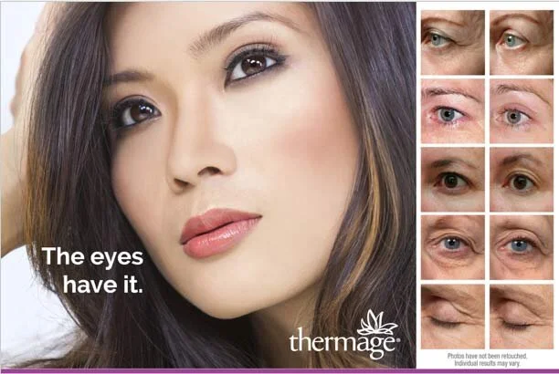 Thermage/Liftera/Vzet /PDO Thread lifting — Tiara Skin & Hair