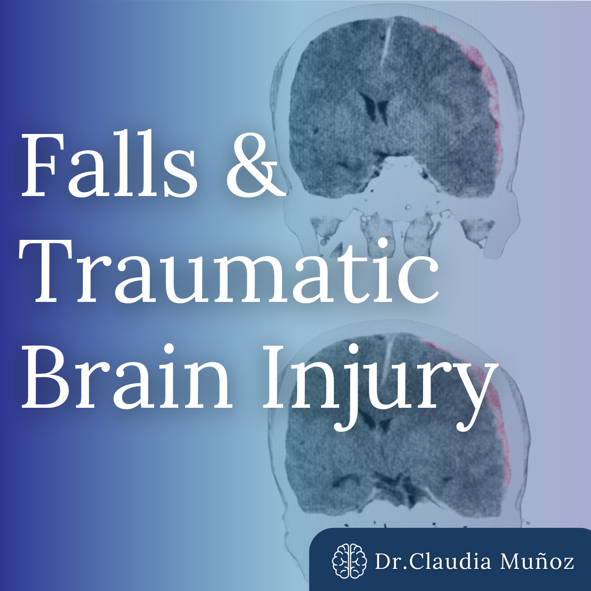 Falls & Traumatic Brain Injury (TBI) — NeuroCurious.com