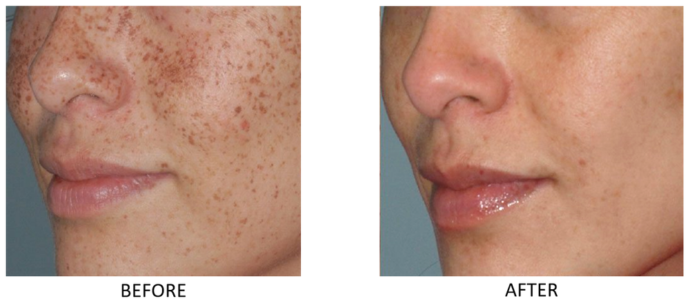 Intense Pulsed Light (IPL) Before & After — Urban Allure