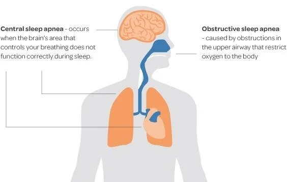 3 Types of Sleep Apnea — Sleeptopia, Inc | CPAP Supplies