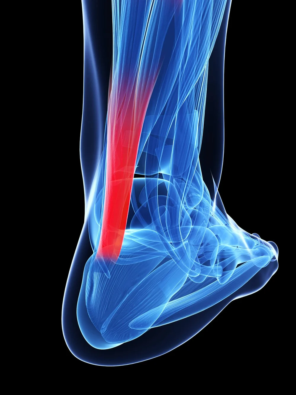 Achilles Tendinopathy | Refine Health