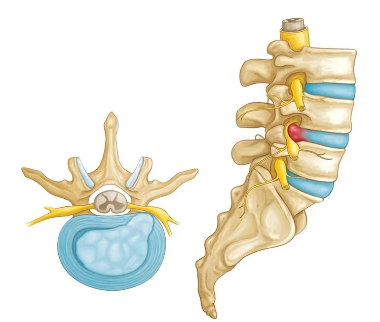 Lumbar Discs - Why are they important? | Refine Health